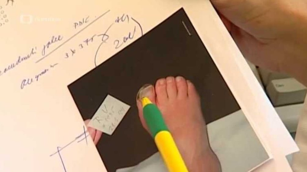 Diabetická noha - Diagnóza | Česká televize
